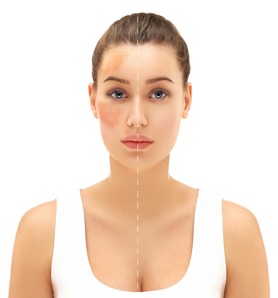 hydroquinone results hyperpigmentation